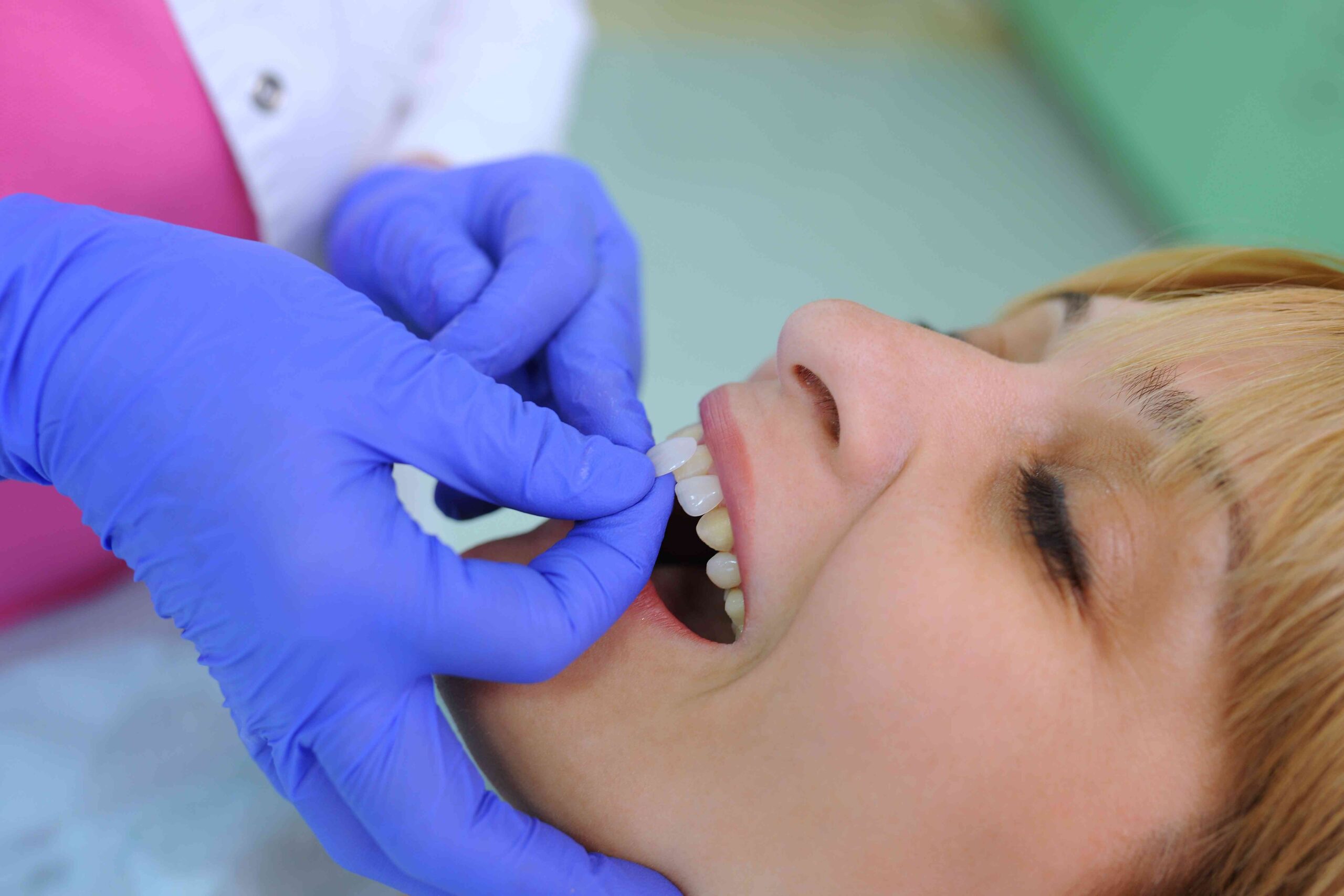 Enamel Removal for Veneers, Carrollton | Anthony Dillard, DDS